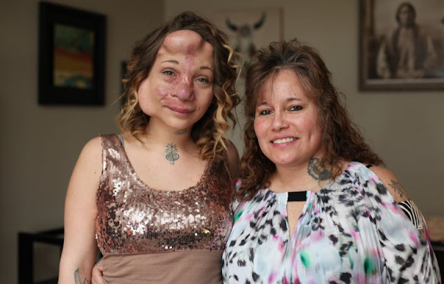 ( 10 Gambar) Wajah Mengelembung Seperti Balon - panas panas