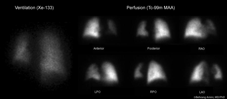 Roentgen Ray Reader: Unilateral Decreased Lung Perfusion