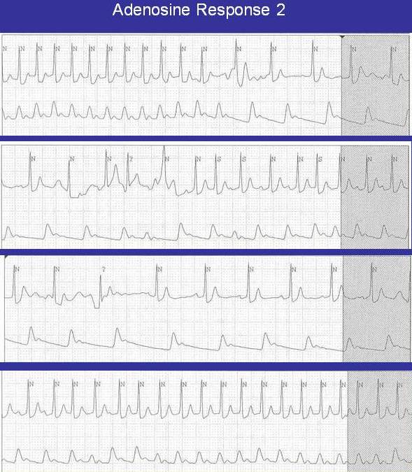 Pedi cardiology: Narrow Complex Tachycardia/SVT - 3 types of responses ...