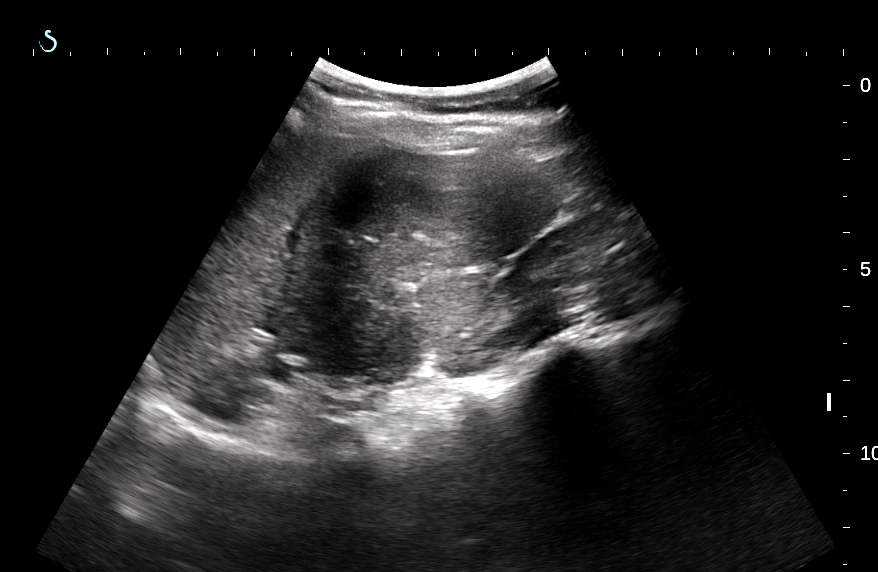 VIETNAMESE MEDIC ULTRASOUND: CASE 393: SPLEEN TUMOR, Dr PHAN THANH HẢI ...