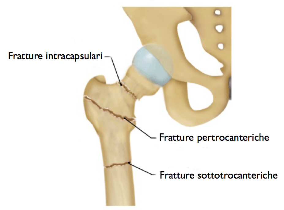 ®FisioRiab : Le fratture dell'anca nell'anziano.