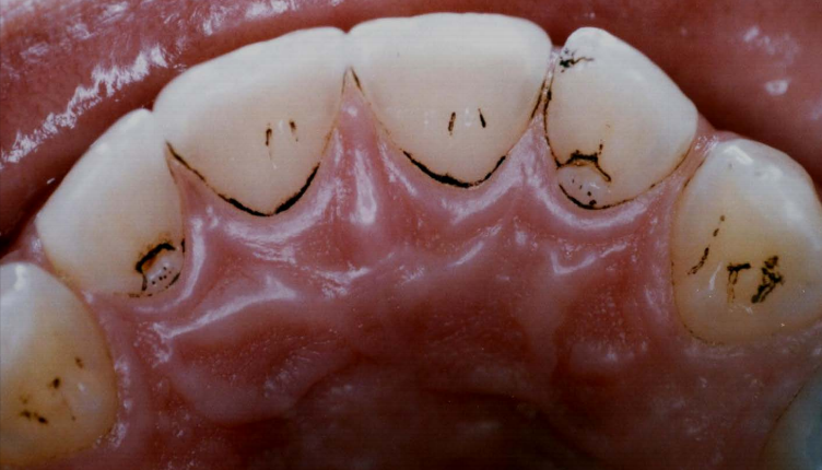 Odontosabara: Bactérias Cromogênicas, sabe o que fazem?