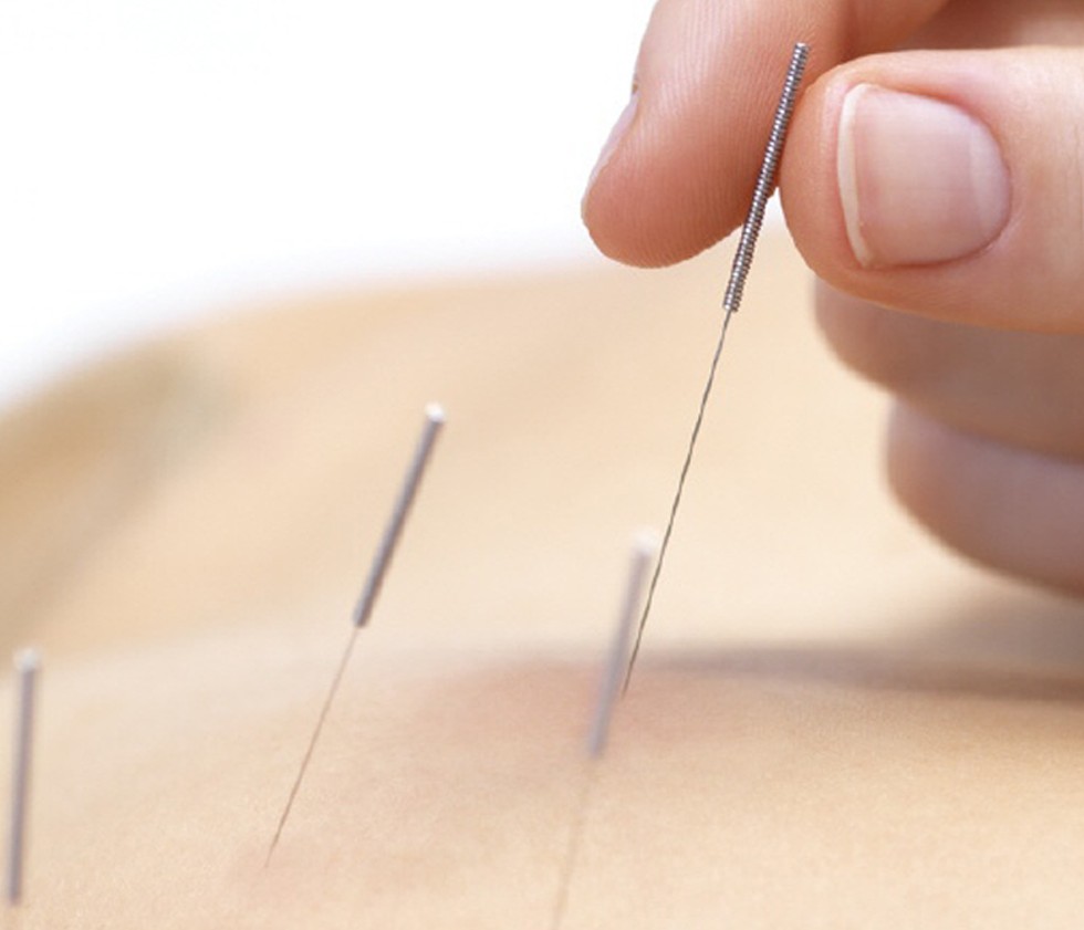 CENTRO INTEGRAL DE EDUCACIÓN PARA LA SALUD: Que es la Acupuntura.