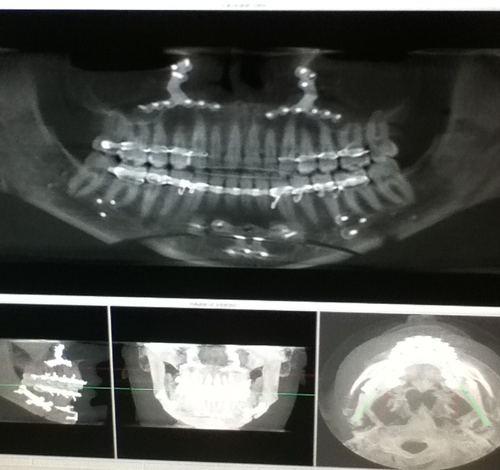 Hilary's Broken Face: lotsa x-rays: before and after