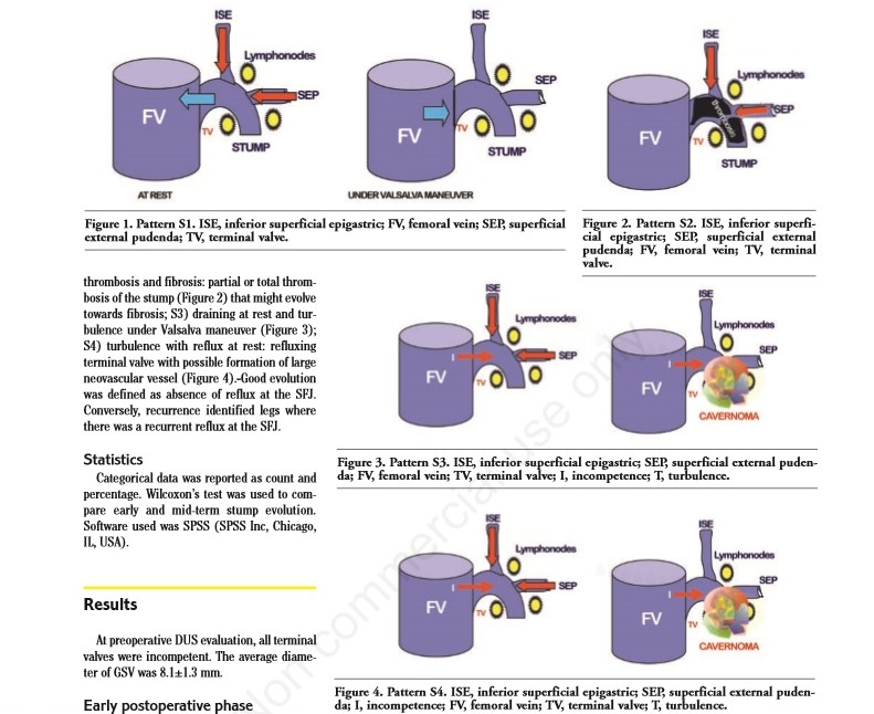 Vascular Mind : STUMP EVOLUTION AFTER GREAT SAPHENOUS VEIN STRIPPING ...
