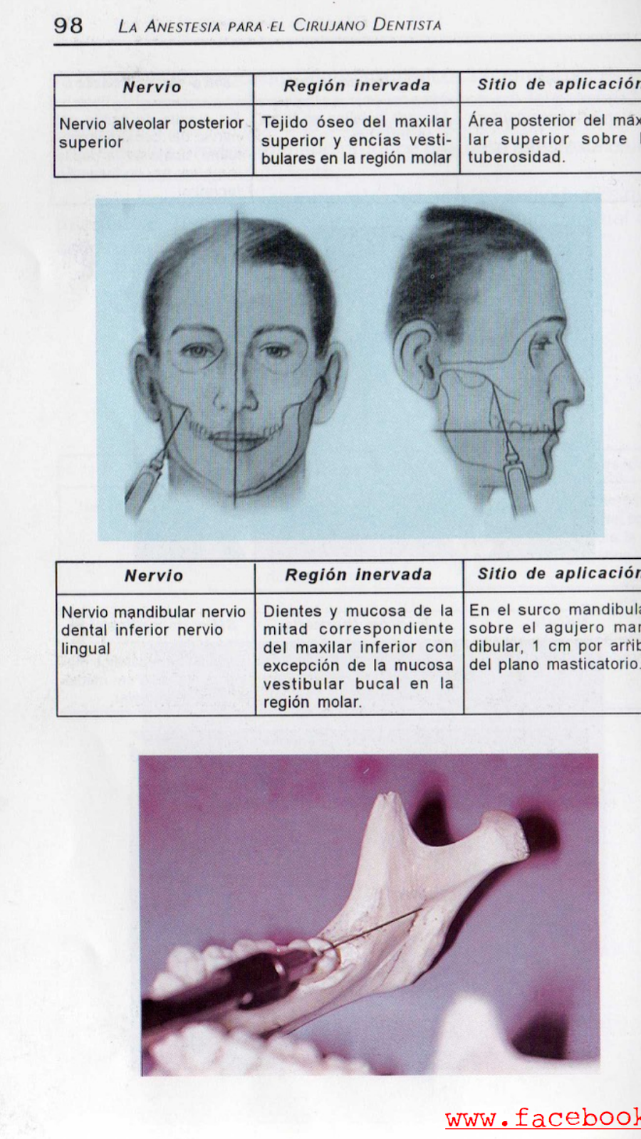 FUNDAMENTOS DE ANESTESIA Y EXODONCIA : TECNICAS DE ANESTESIA INTRAOALES