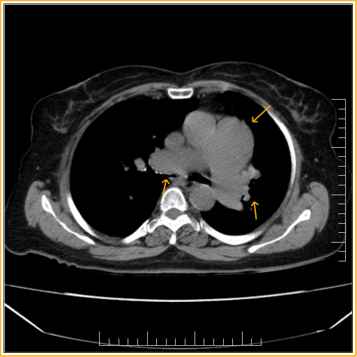 Long standing left to right shunt-CT - Sumer's Radiology Blog