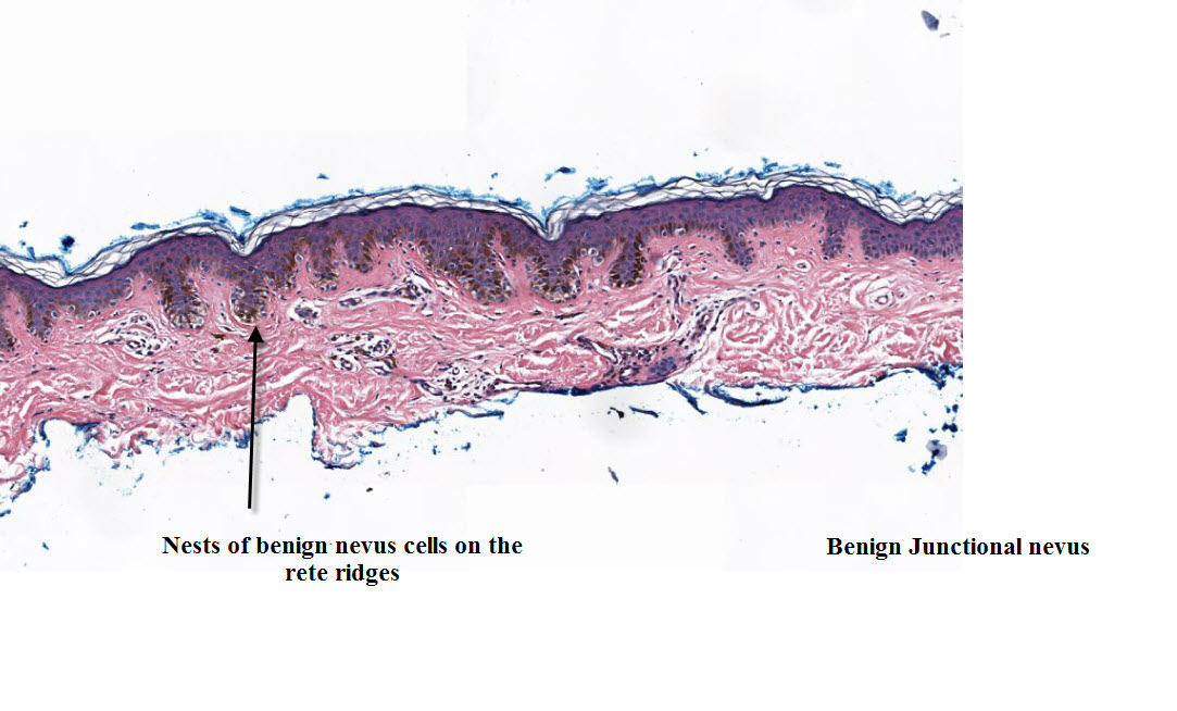 Dermpath Made Simple - Neoplastic: Benign Nevi