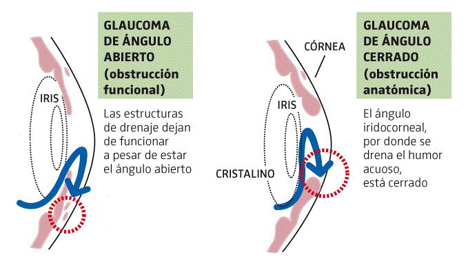 El Glaucoma | Medicusmeo