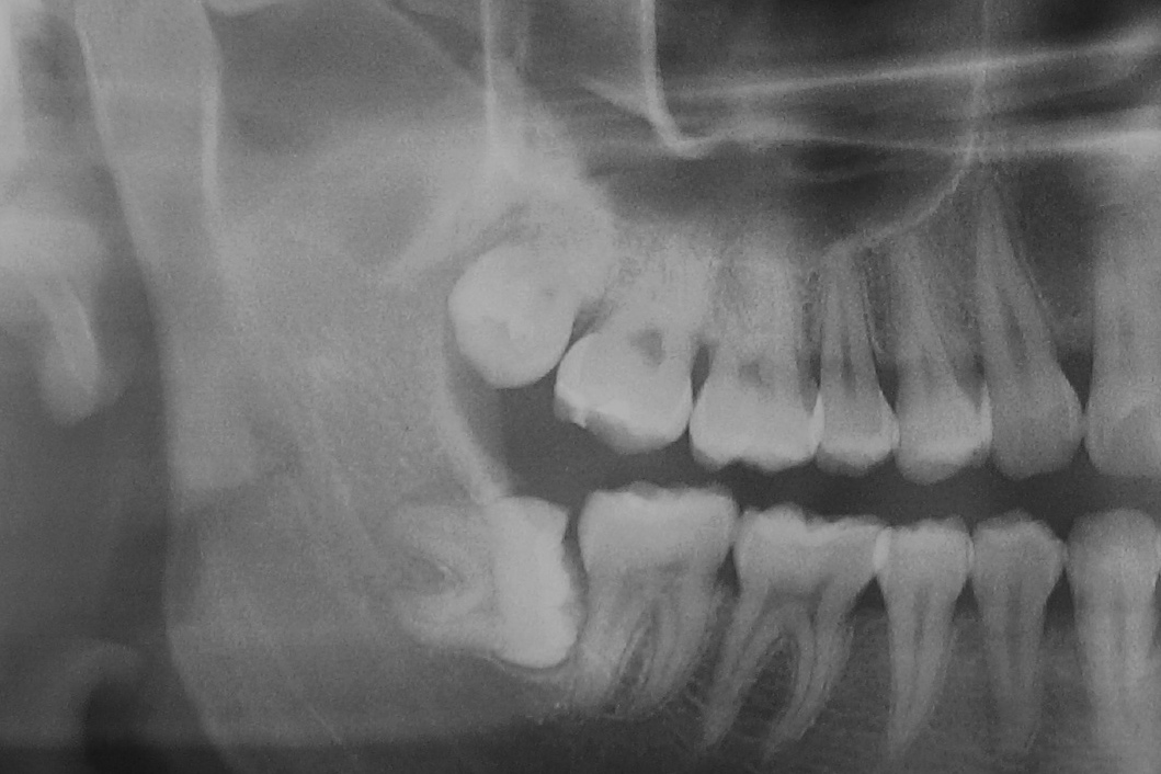 Dr Felipe Coppini: Extração dos Sisos: Quando tirar?