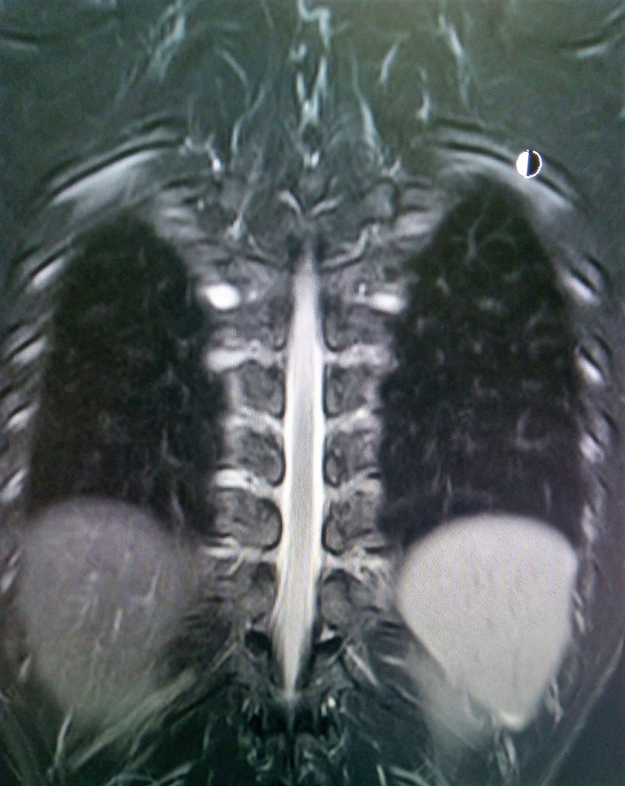 Chronic inflammatory demyelinating polyradiculoneuropathy (CIDP): MRI ...