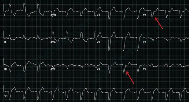 Cabrera's Sign | INA - ECG