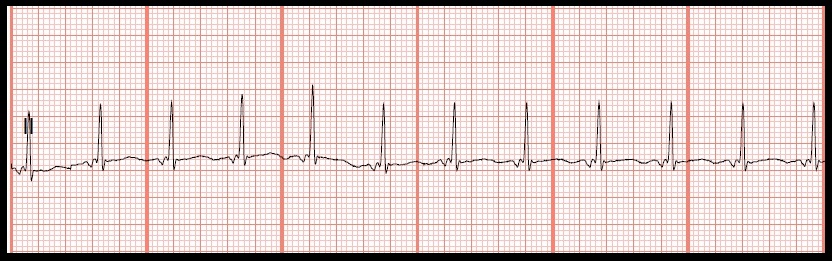 Characteristics of Junctional Rhythms