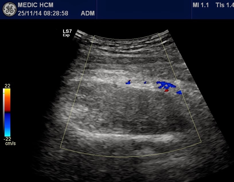 VIETNAMESE MEDIC ULTRASOUND: CASE 283: SCARPA TRIANGLE MASS, Dr PHAN ...