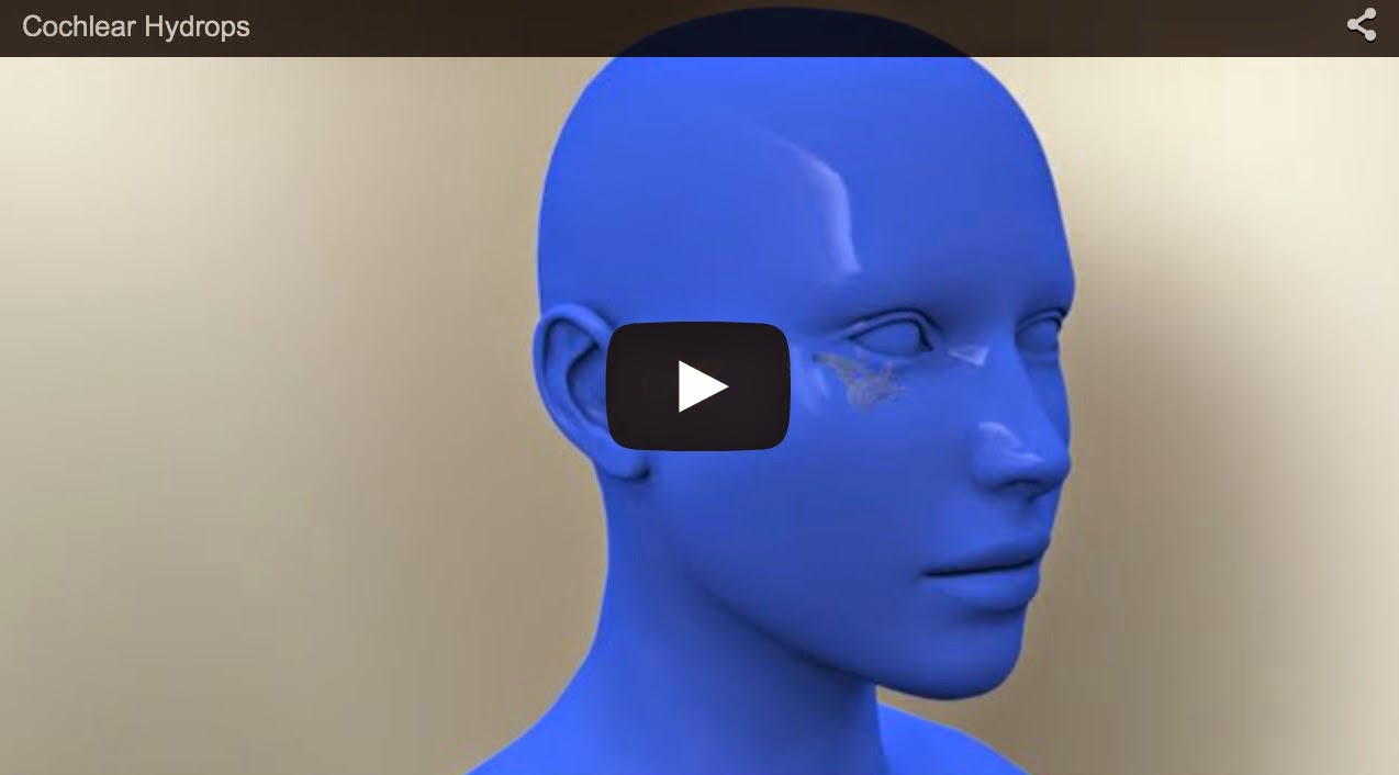 Video of Cochlear Hydrops (What Happens in the Inner Ear) | Fauquier ...