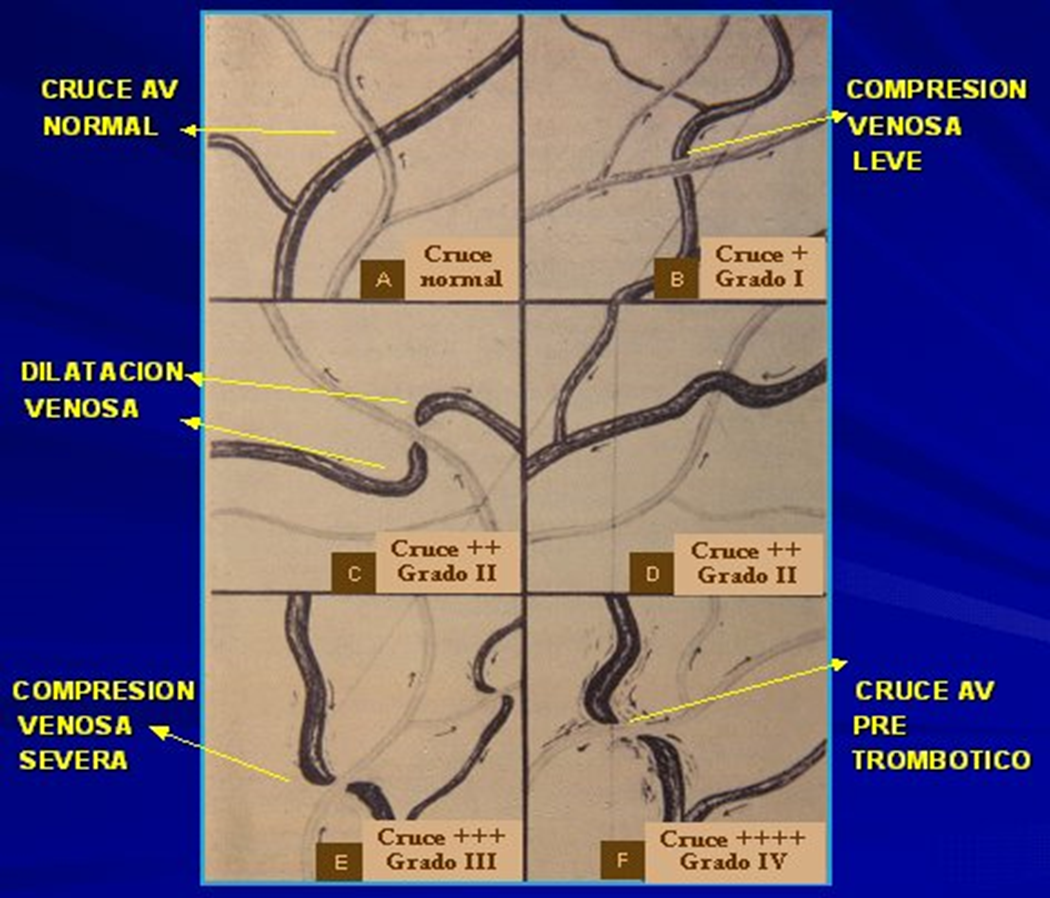 Retinopatía Hipertensiva