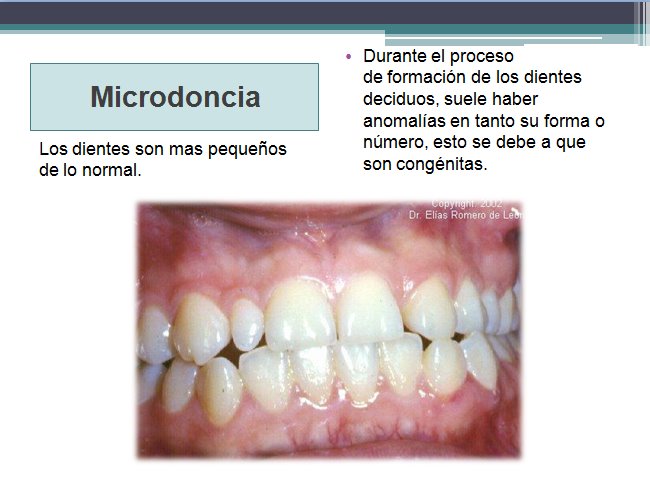 DENTAL 1001 UNAM: Macro y Microdoncia, y otras Anomalías Dentales ...