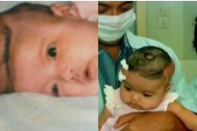 LAHIR KEMBAR SIAM DENGAN DEMPET KEPALA 29 TAHUN LALU, BEGINI KABAR ...