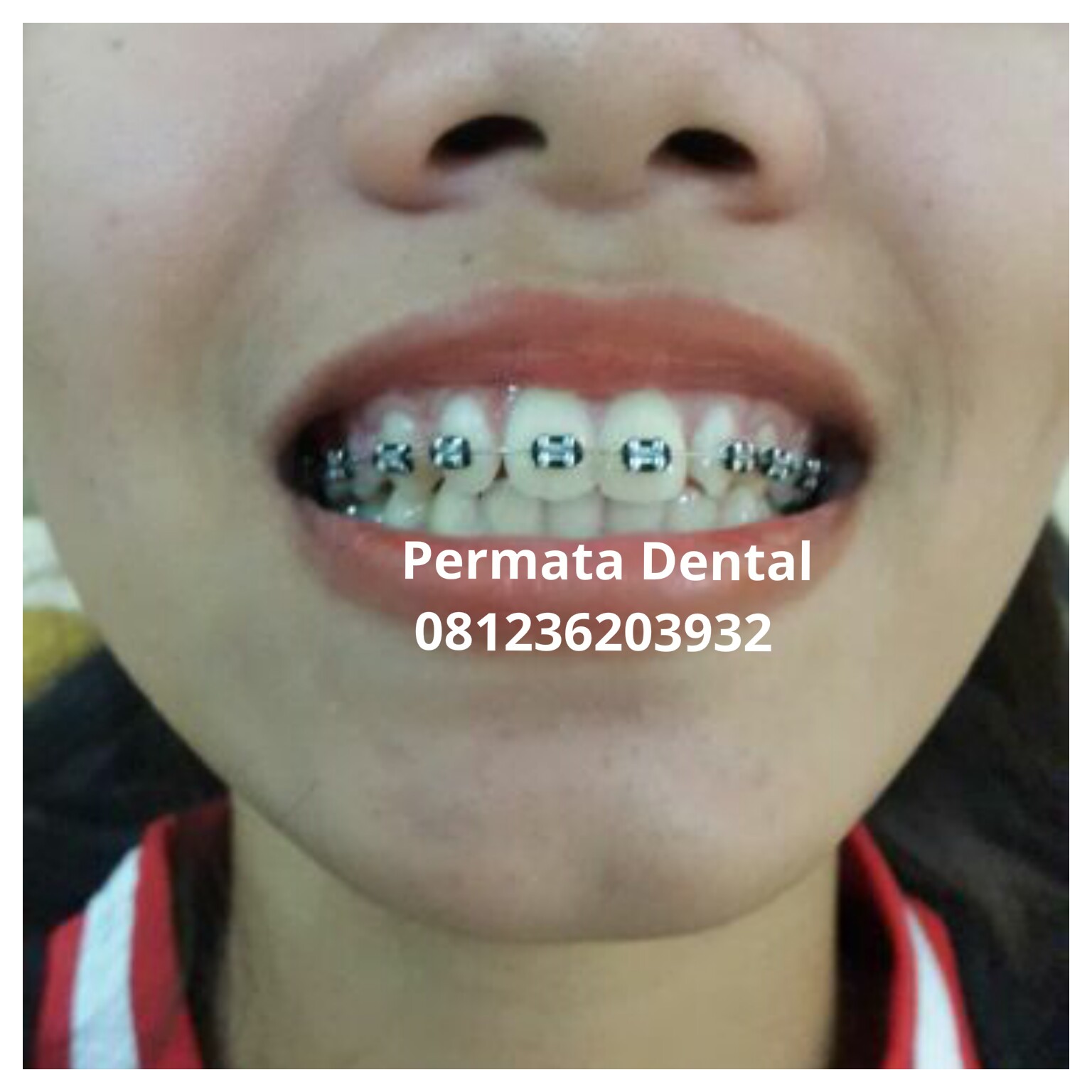 DOKTER GIGI BALI: Behel | Barcket | Kawat Gigi Perawatan