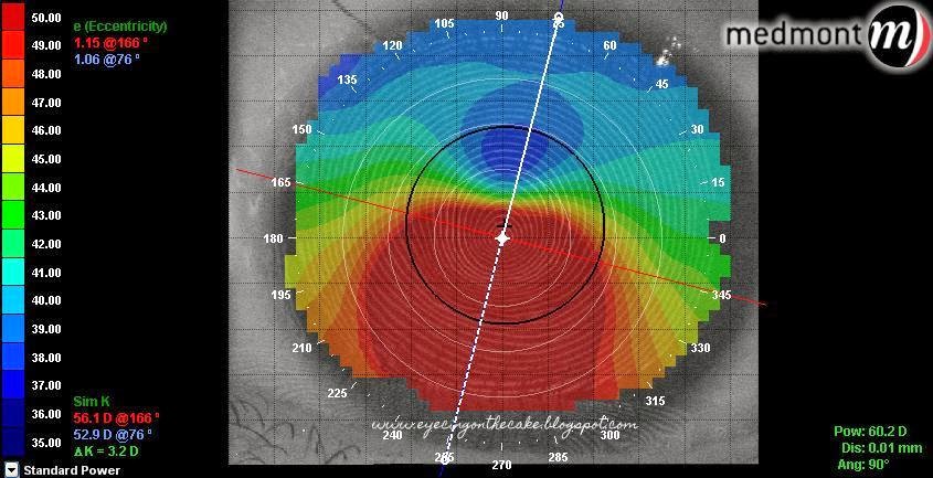 eyecing on the cake: Keratoconus