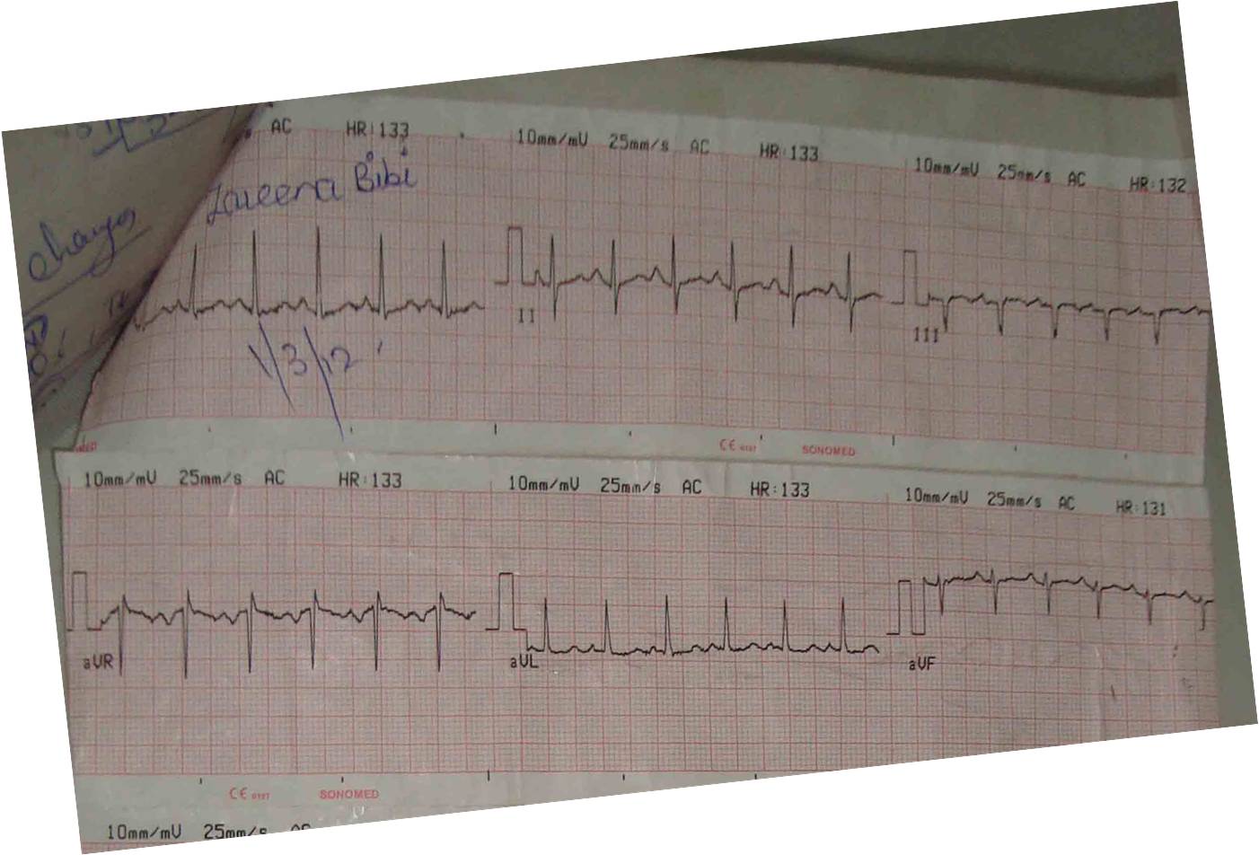 Pulmonary Embolism Patient- Clinical Scenario and Diagnosis-