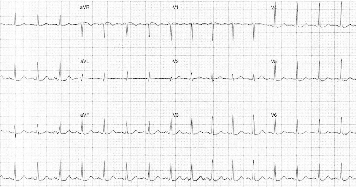 ECG of the Week: ECG of the Week - 6th March 2017 - Interpretation