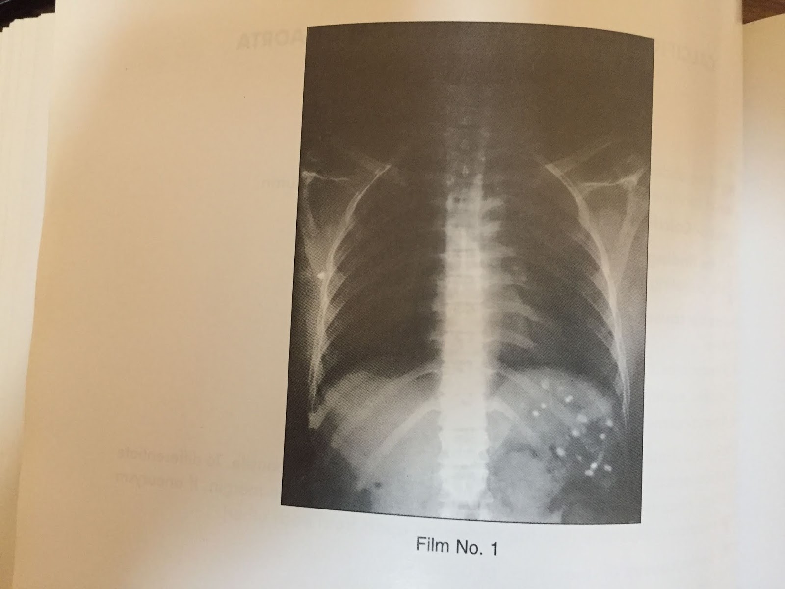 XRAYS OF SPLENIC CALCIFICATION