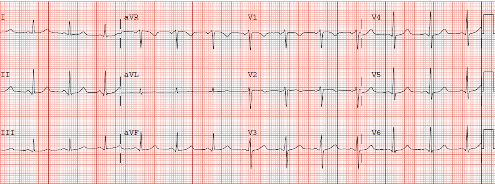 Dr. Smith's ECG Blog: May 2014