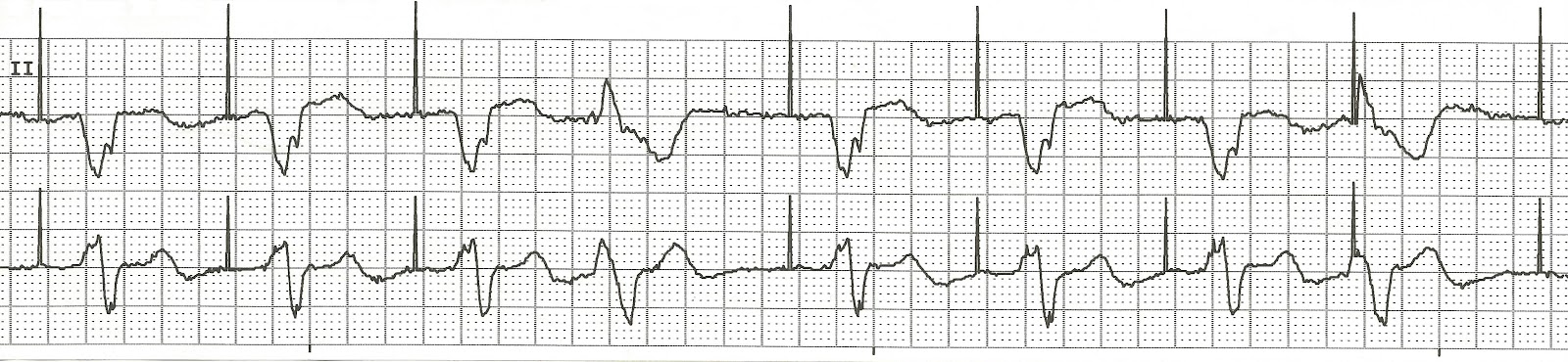 EKG Rhythm Strips 83