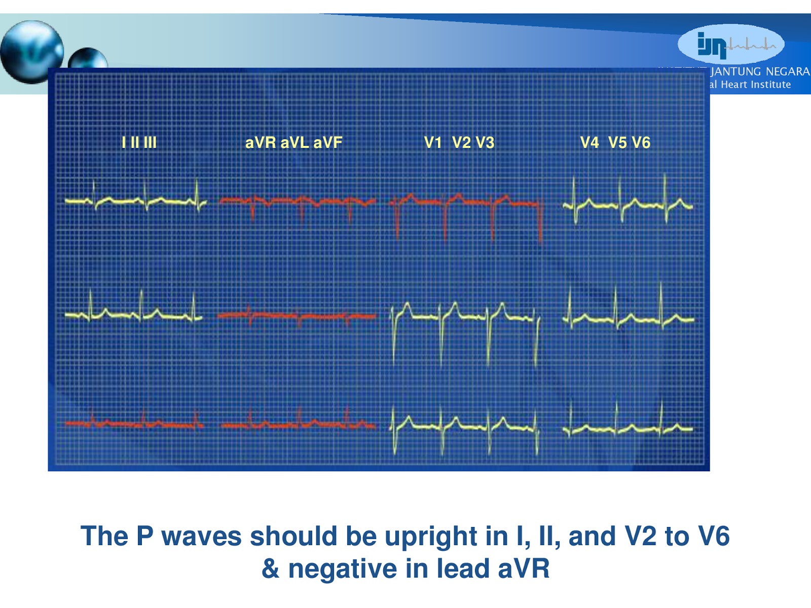 CVT Mohd Farid: Basic ECG Part III-P Wave & PR Interval