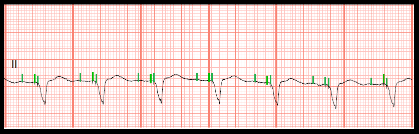 Practice EKG Strips