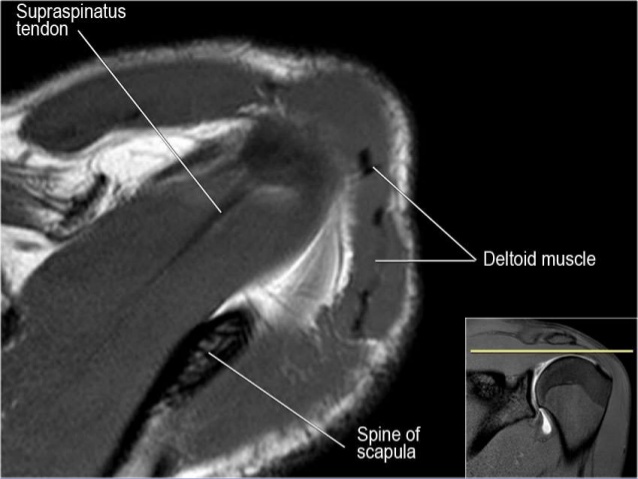 MRI Musculo-Skeletal Section: MRI anatomy of the shoulder (axial view)
