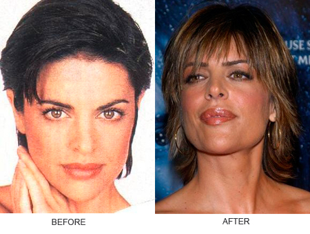 Lisa Rinna Lips Before And After