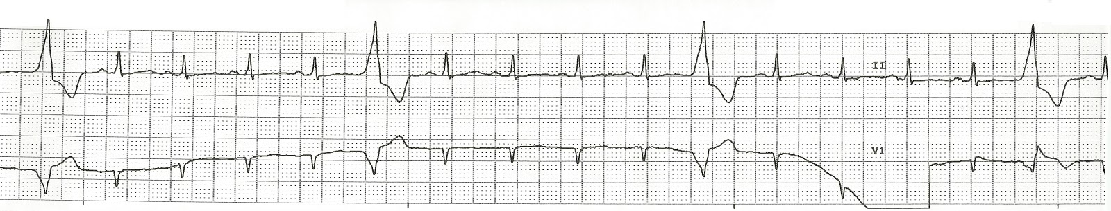 EKG Rhythm Strips 81: Bigeminy, Trigeminy, Quadrigeminy...