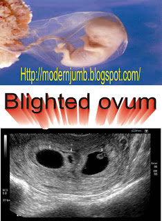 IPA: Blighted ovum