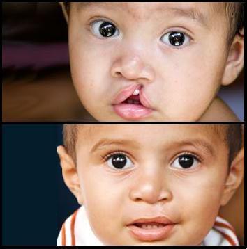 NEWSMILE-TACNA: LABIO LEPORINO Y PALADAR HENDIDO