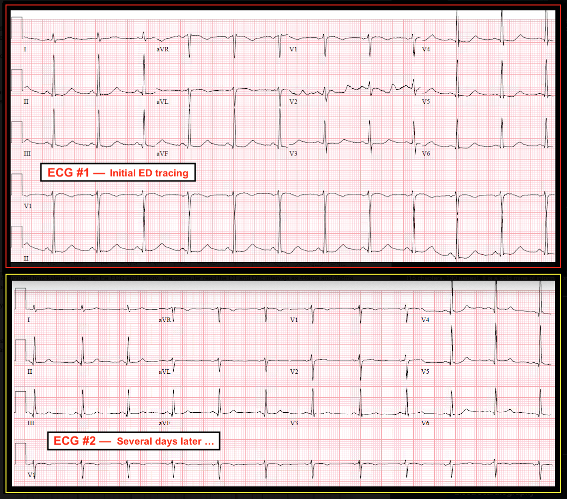 รายการ 99+ ภาพ Ekg 1 ช่องเล็ก คมชัด