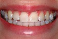 Tecnicas de Ayuda Odontologica (TAO): -CRONOLOGÍA DE LA DENTICIÓN HUMANA-