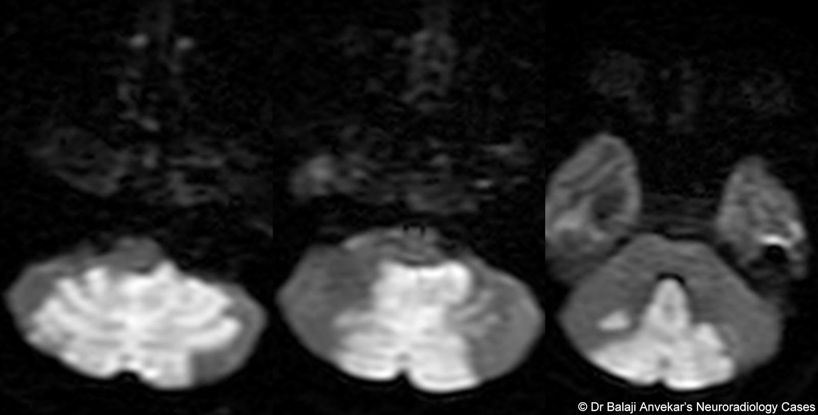 Dr Balaji Anvekar FRCR: Infarct in territory of bilateral medial ...