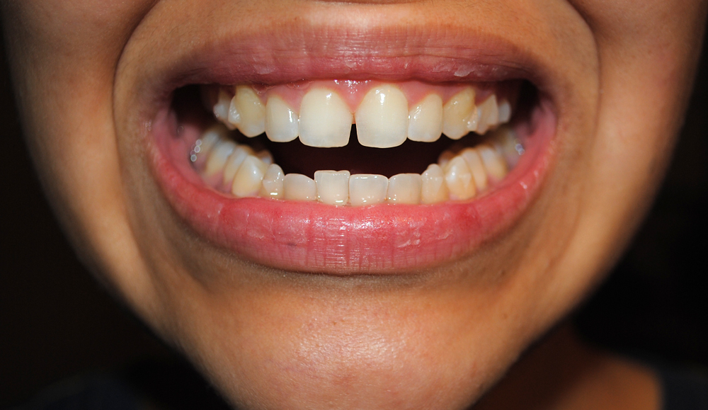 My Life with Invisalign: Week 4 and Week 5