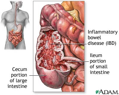 Precious Gift: Inflammatory bowel disease