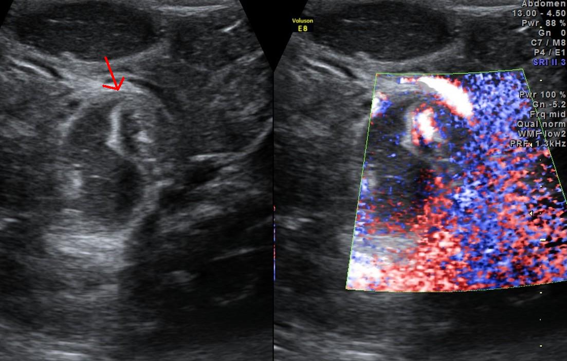 Whirlpool Sign-Ultrasound - Sumer's Radiology Blog