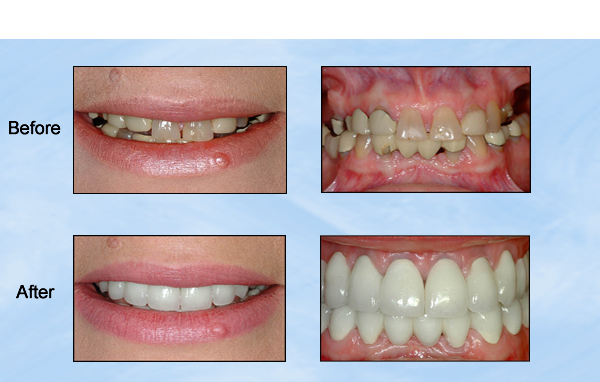 Odontology Student: Introduction to Prosthodontics