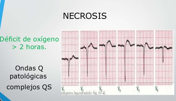 ELECTROCARDIOGRAFÍA BÁSICA PARA ENFERMERÍA: ISQUEMIA-INFARTO