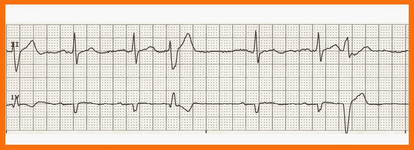 EKG Rhythm Strip Quiz 201