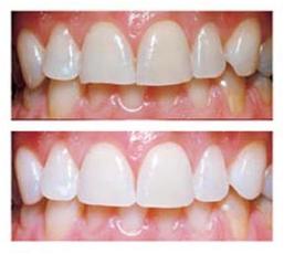 The Sassy Italian: Custom At-Home Teeth Whitening For Less Than $10 ...