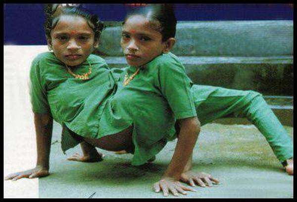 Most Amazing: Double The Tears- “Siamese” Amazing Twins