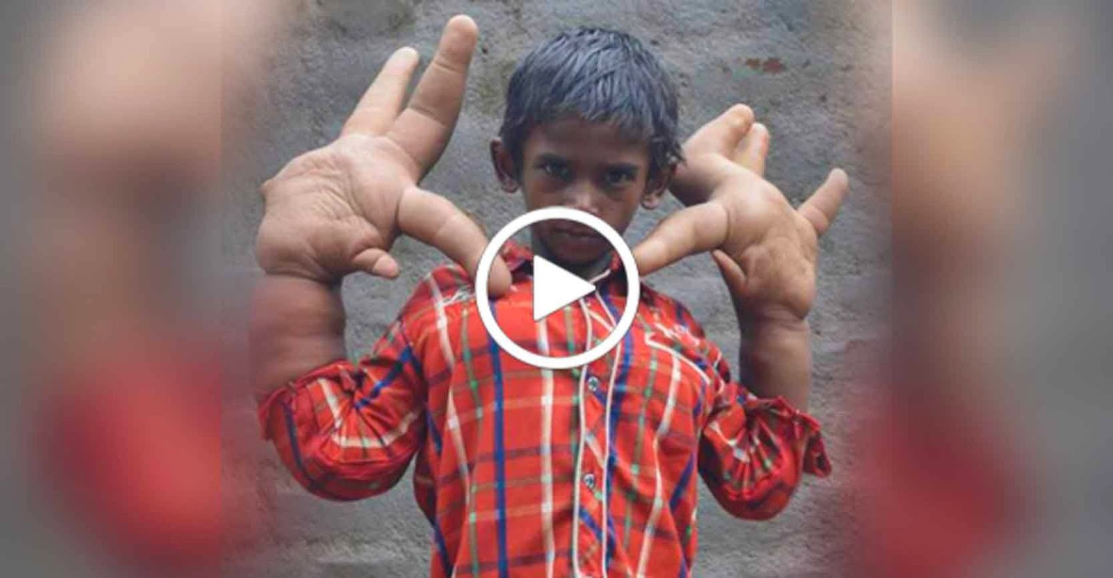 Poor kid with giant hands rejected from school because of his rare ...