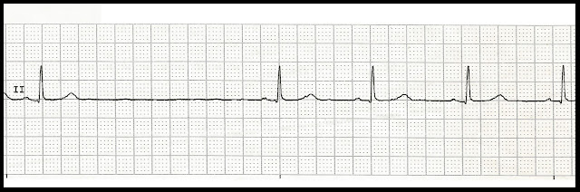 Characteristics of Sinus Rhythms