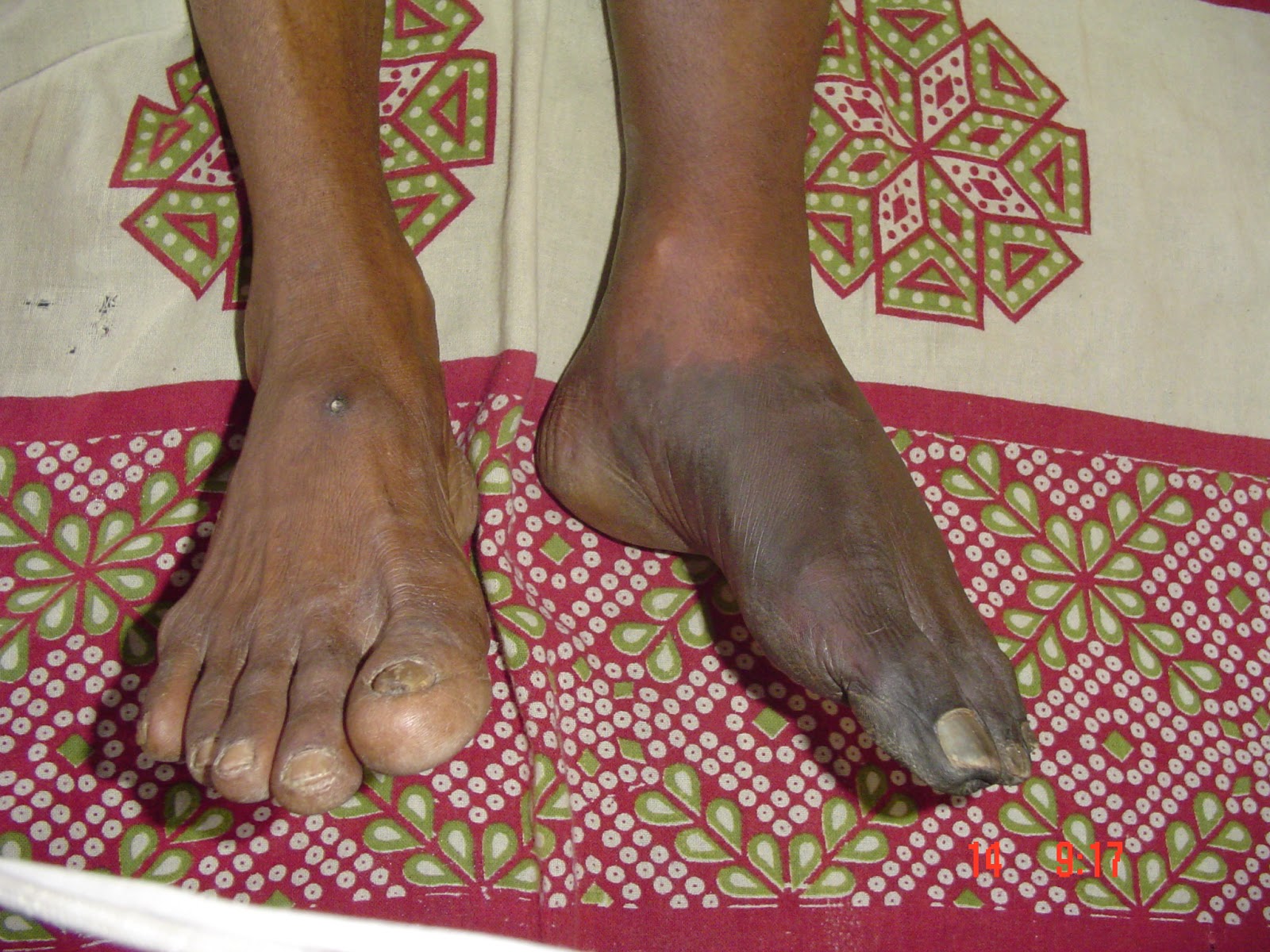 General Surgery Clinics ~ A Surgeon's Blog: Difference between Ischemic ...